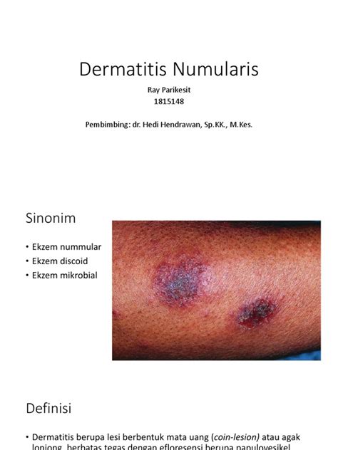 Dermatitis Numularis Pdf Sains And Matematika