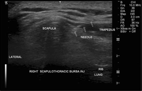 Scapulothoracic Bursitis Diagnosis At Greta Pickard Blog