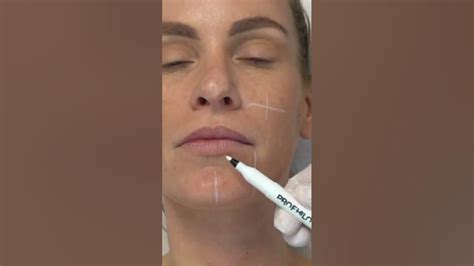 The Bap Technique Consists In Five Injection Points On Each Side Of The Face Profhilo Youtube