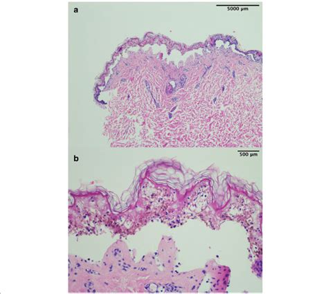 Histological Findings From Skin Biopsy A Low Power Image Showing Download Scientific Diagram