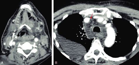 A Abscess In The Floor Of The Mouth With Horseshoe Morphology With