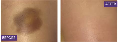 Body Scar Coverage Makeup