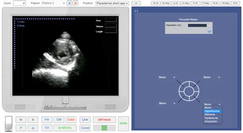 Lv Local Systolic Function