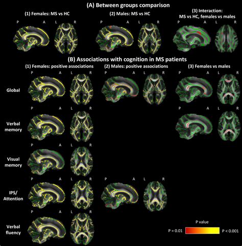 Wm Microstructural Abnormalities A Voxel Wise Fa Values Differences