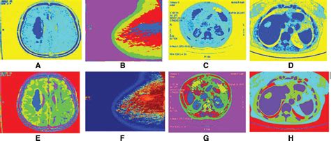 an overview of segmentation algorithms for the analysis of anomalies on