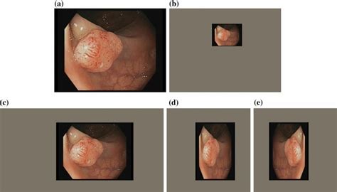 Example Of The Data Augmentation Steps Applied To A Sample Polyp Image Download Scientific