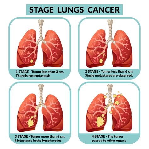 Stages Of Lung Cancer 1 4