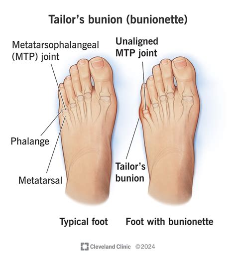 Swollen Pinky Toe How To Stop Shoes Rubbing On Your Little Toe