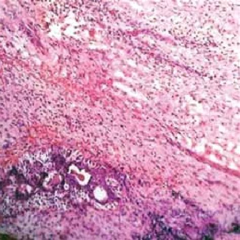 Pdf Oral Teratoma With A Primitive Neuroectodermal Tumor Component A Case Report