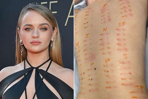 Joey King Shows Her Allergy Test Results In New Picture
