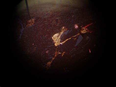 Hematoxylin And Eosin H And Estaining Of Lymph Node Infiltrated By