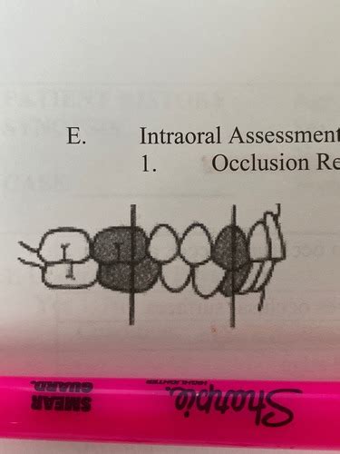 Angles Classifications For Permanent Dentition Flashcards Quizlet