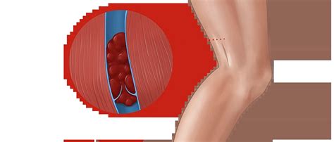 Deep Vein Thrombosis Penumbra Inc