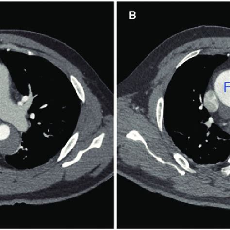 The Shape Of The False Lumen At The Ascending Aorta Could Be Classified