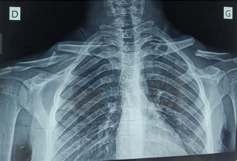 Figure 1 From Bilateral Clavicle Fracture A Case Report Semantic Scholar