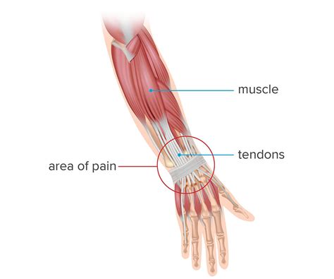 Muscle Ligament Tendon Injuries Montreal Toronto Ottawa Gatineau