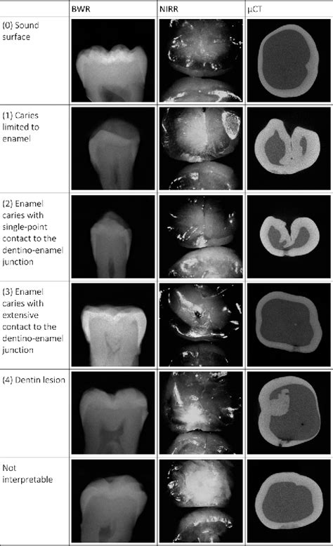 Figure 1 From In Vitro Validation Of Near Infrared Reflection For Proximal Caries Detection