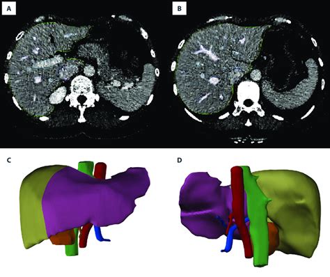 Liver Segmentation Using Mimics Software Program A B The Liver Was