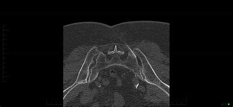 Sacroiliac Joint Patient Guide Melbourne Radiology