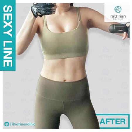Sexy Line Liposuction To Get Line Abs Within Seven Days