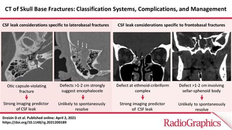 Ct Of Skull Base Fractures Classification Systems Complications And