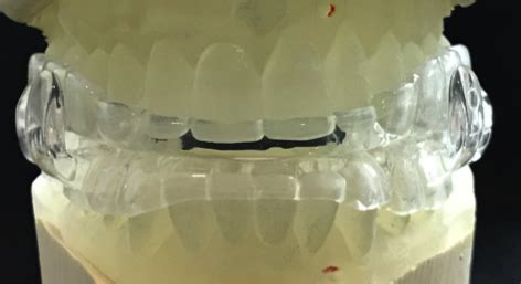 Tmj Oral Appliances Tmj Specialist Nyc The Gelb Center
