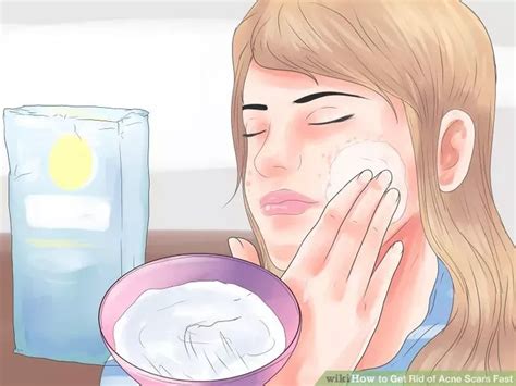 Ways To Get Rid Of Acne Scars Fast Wikihow Artofit