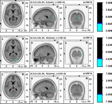 Source Localization Results Based On Sloreta Participants With Low