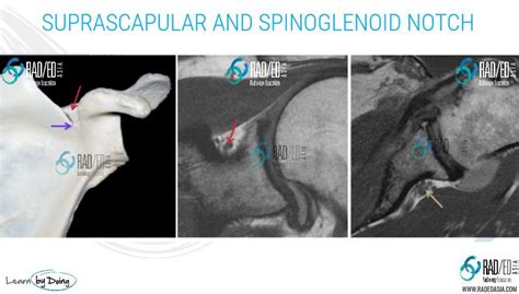 Spinoglenoid Notch