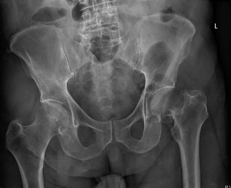 Hip Fractures — Kwak Talk