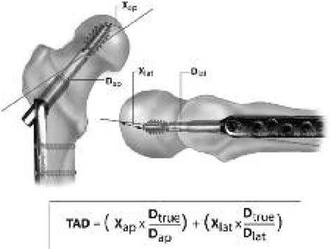 Measurement Of Tip Apex Distance TAD Download Scientific Diagram