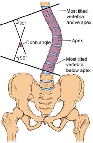 Cobb Angle Measurement With Reference Lines [6] Download Scientific Diagram