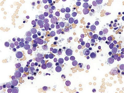 Pure Erythroid Leukemia Stock Image Image Of Laboratory 342188319