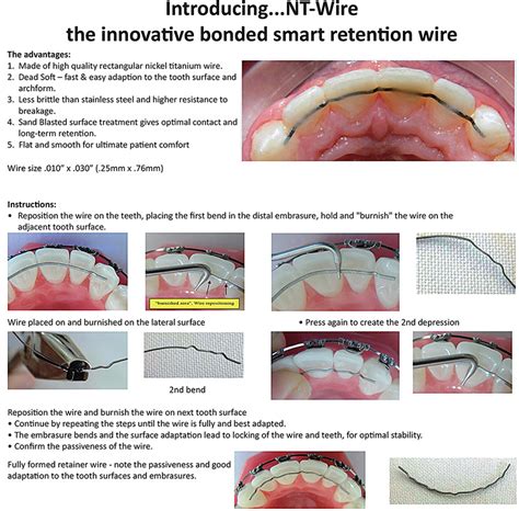 Ortho Retention Wire At Joseph Stanfield Blog