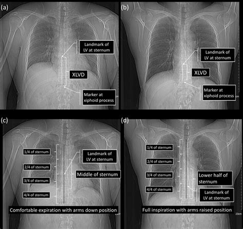 Bifurcated Xiphoid Process At Margret Gallucci Blog