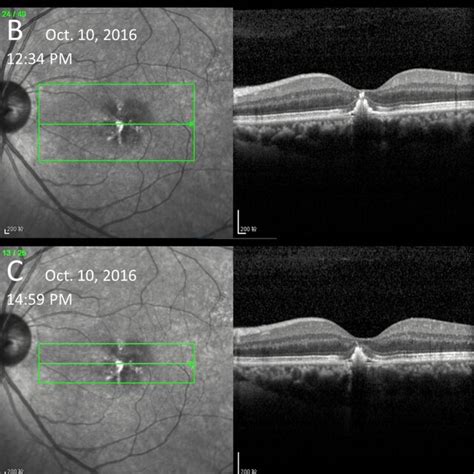 OCT Images Of The Patient At The First Follow Up A The PED Existed In Download Scientific