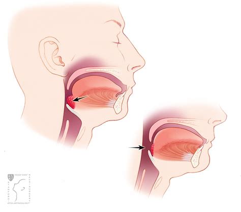 Lingual Tonsillectomy Stanford Health Care