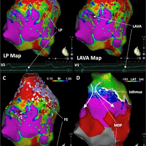 Egm Based Substrate Ablation 54 Year Old With Sarcoidosis And Vt Download Scientific Diagram