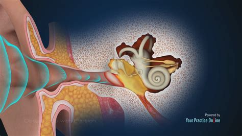 Otitis Media With Effusion Video Medical Video Library