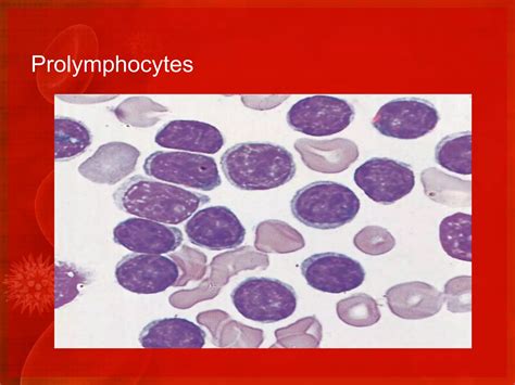 Chronic Lymphocytic Leukemia Pptx