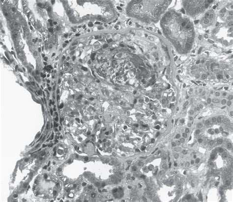 Glomerulonephritis Clinical Tree