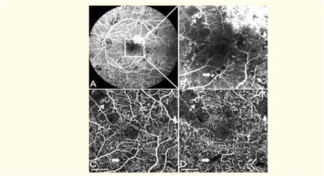 Thin Arrow Shows An Intraretinal Microvascular Abnormality Well Download Scientific Diagram