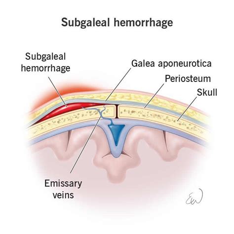 Subgaleal Hemorrhage Symptoms And Risks Wockr