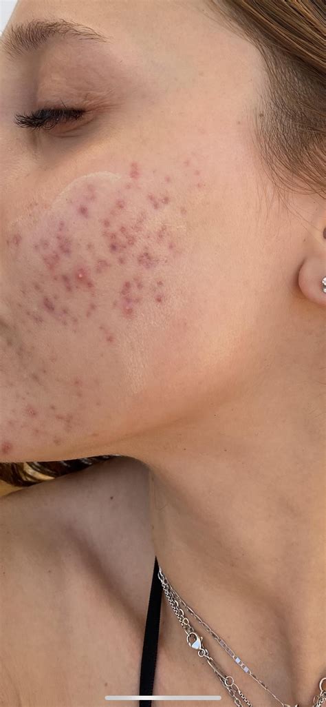 More Pics From Accutane Transformation Raccutane