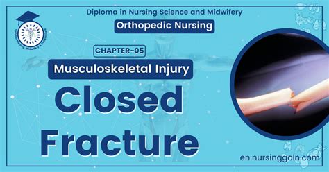 Closed Fracture Chapter 5 Orthopedic Nursing Nursing And Midwifery Gurukul Goln