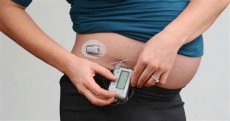 automated insulin delivery revolutionizes maternal health