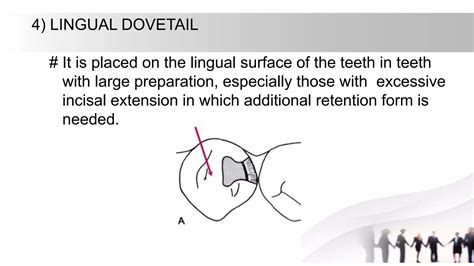 Class Iii Cavity Preparation Pptx Dental Health Diseases And