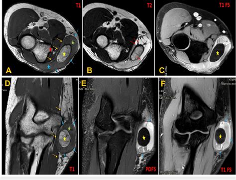Selected Multiplanar Multisequence Mri Of The Left Elbow Using Download Scientific Diagram