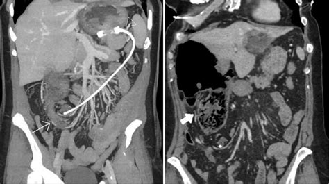 Cecal Volvulus Secondary To Gastric Band Surgery Case Reports In