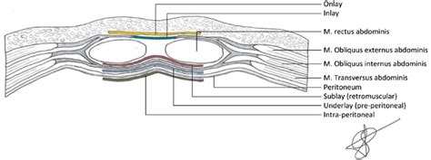 Types Of Mesh Placement Onlay Inlay And Underlay Wfhp